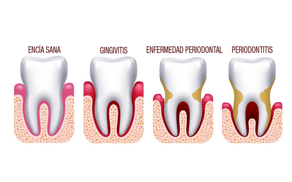 ¿Cuáles son las causas de la enfermedad periodontal? - Solución Dental ...