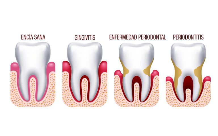 ¿Cuáles son las causas de la enfermedad periodontal? - Solución Dental ...