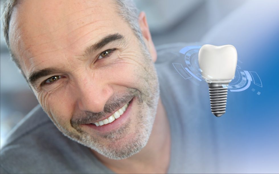 ¿Implantes dentales para tu boca? - Solución Dental Embajadores